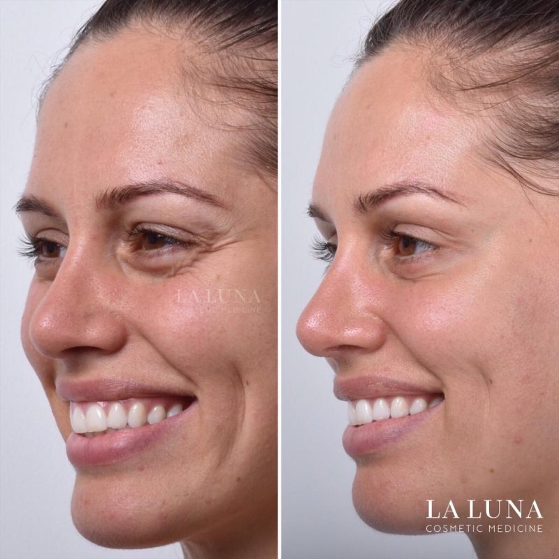 Fine Lines | Anti Aging Treatments | La Luna Cosmetic Medicine