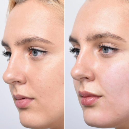Thread Lift Sydney - Thread Face Lift - Fox Eye - Cheek - Neck Jowl Lift