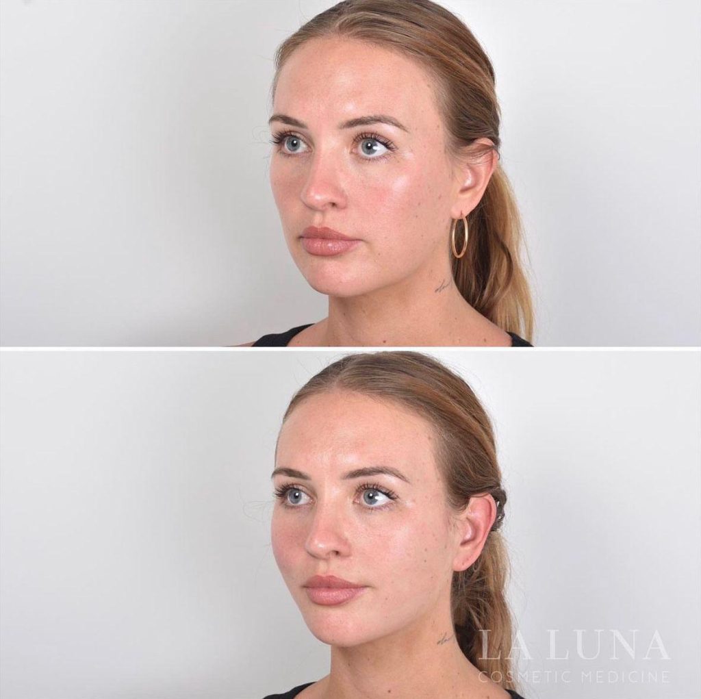 Thread Lift Sydney - Thread Face Lift - Fox Eye - Cheek - Neck Jowl Lift