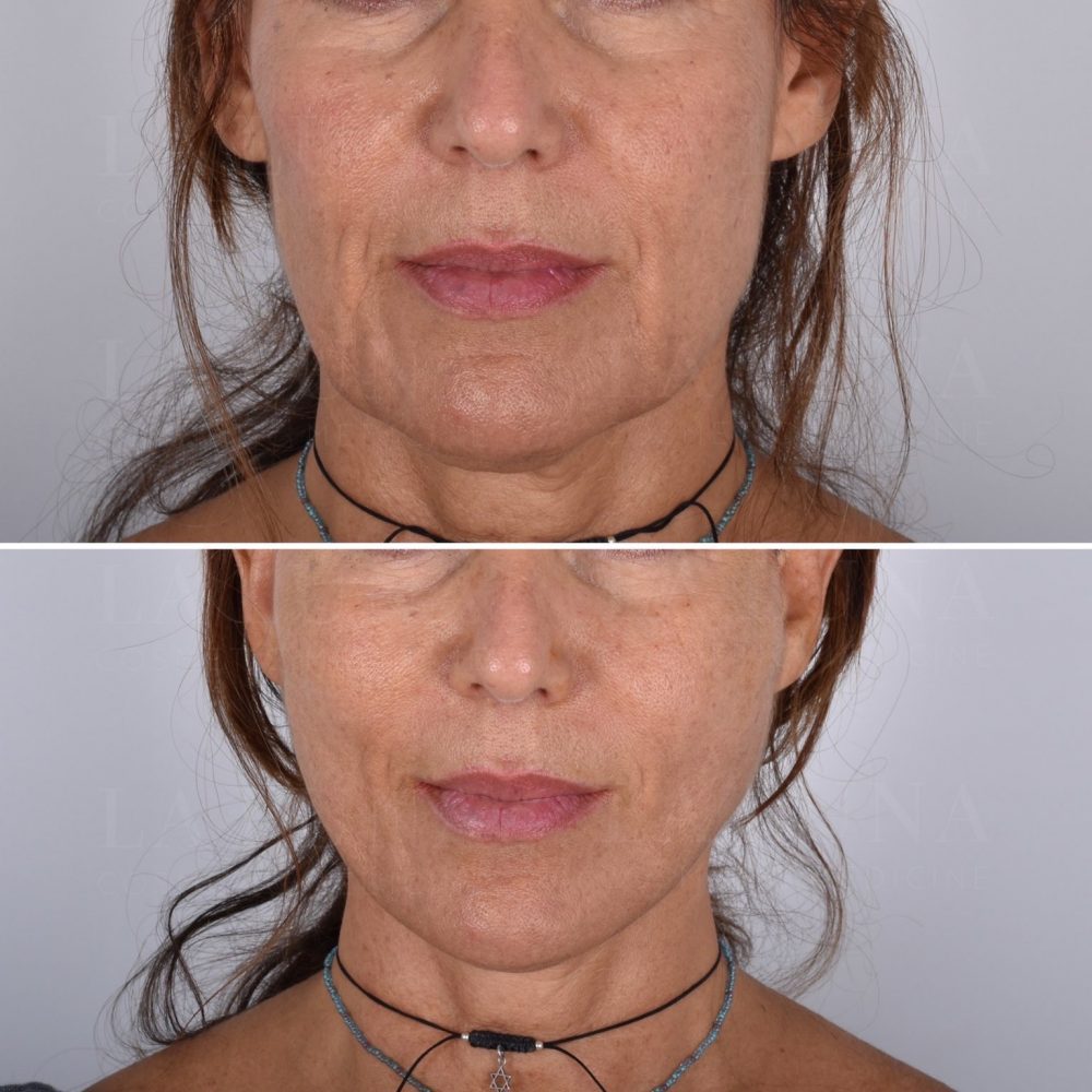 Thread Lift Sydney - Thread Face Lift - Fox Eye - Cheek - Neck Jowl Lift