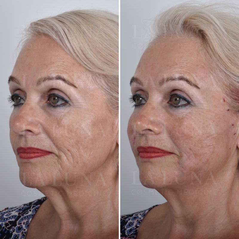 Thread Lift Sydney - Thread Face Lift - Fox Eye - Cheek - Neck Jowl Lift