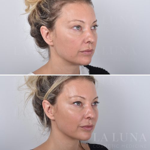 Thread Lift Sydney - Thread Face Lift - Fox Eye - Cheek - Neck Jowl Lift