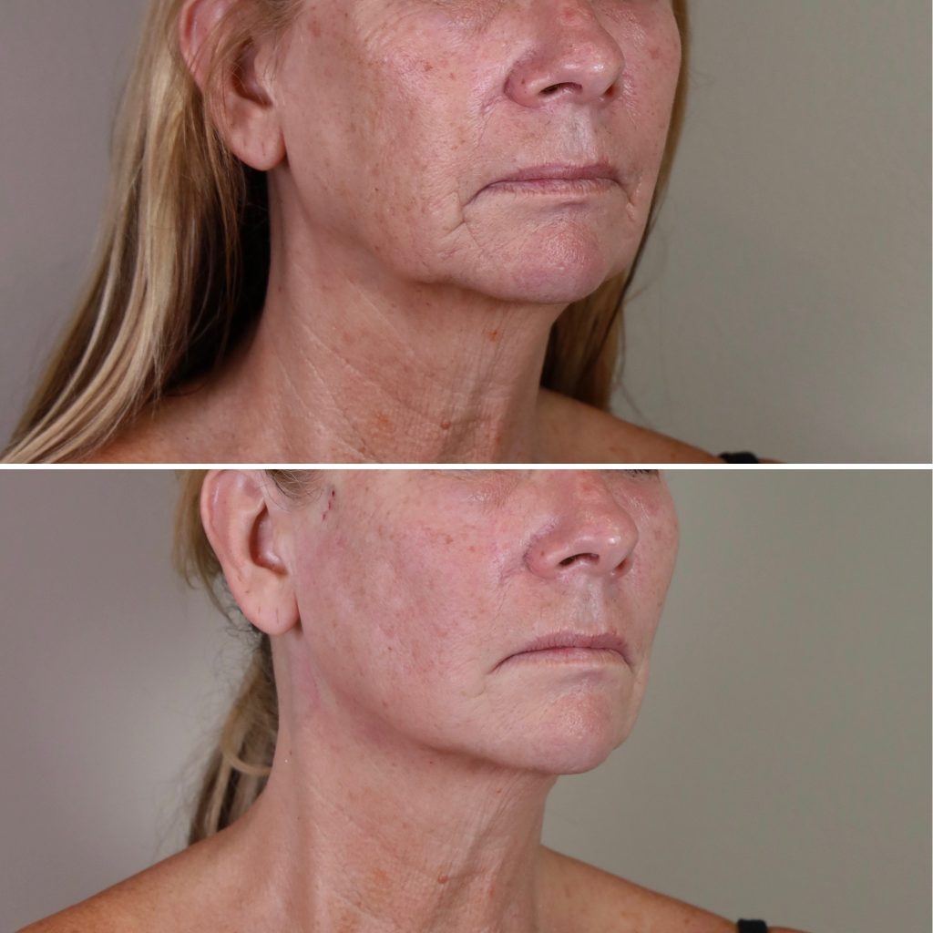 Thread Lift Sydney - Thread Face Lift - Fox Eye - Cheek - Neck Jowl Lift