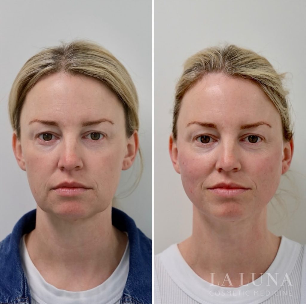 Thread Lift Sydney - Thread Face Lift - Fox Eye - Cheek - Neck Jowl Lift