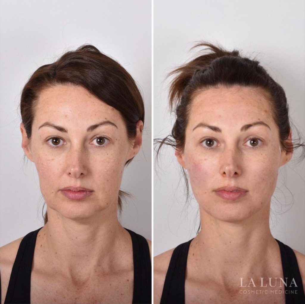 Thread Lift Sydney - Thread Face Lift - Fox Eye - Cheek - Neck Jowl Lift